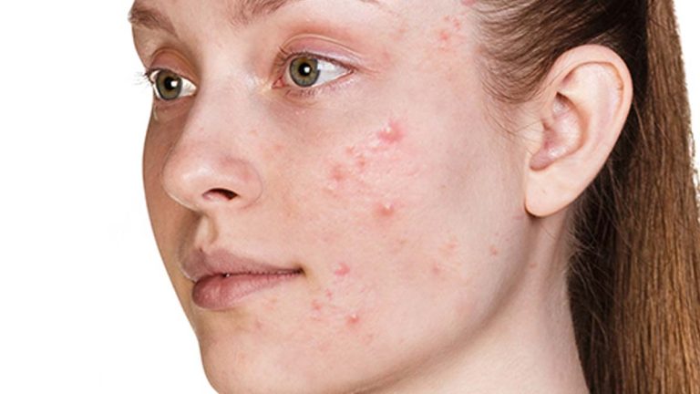 The Safest Acne Scar Removal Treatment Using Dual-Functional RF ...