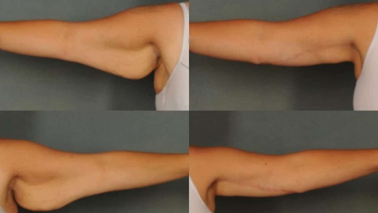 Surgical and Non-Surgical Arm Lifting (Brachioplasty) Cosmetic ...